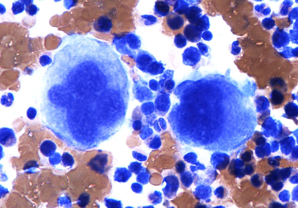 Stemline’s BPDCN drug receives FDA approval
